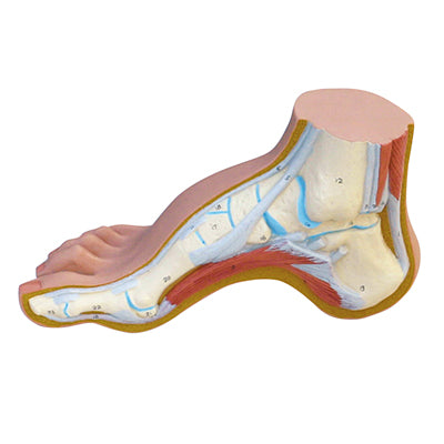 3B Scientific Anatomical Model - Hollow Foot (Pes Cavus) - Includes 3B ...