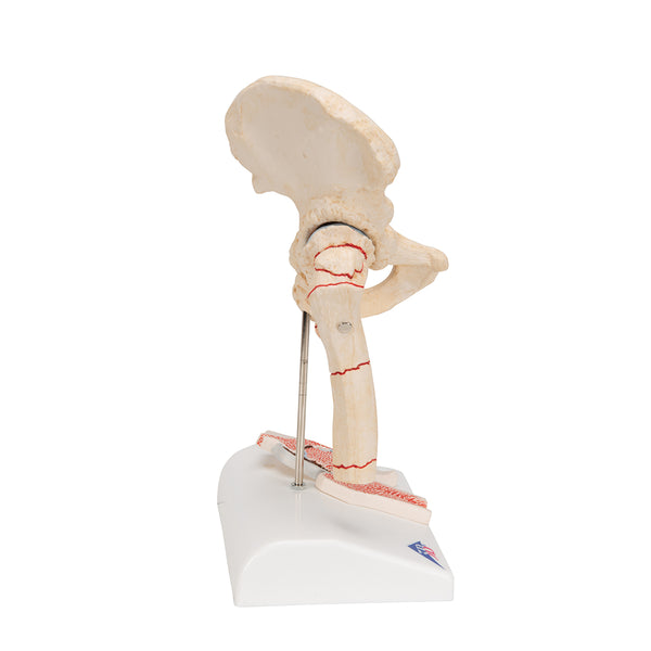 Human Femoral Fracture & Hip Osteoarthritis Model - 3B Smart Anatomy ...